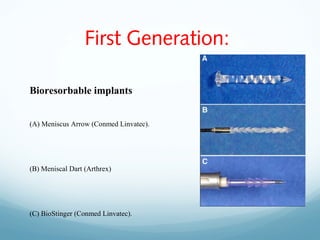 MENISCUS REPAIR I Dr.RAJAT JANGIR JAIPUR | PPT