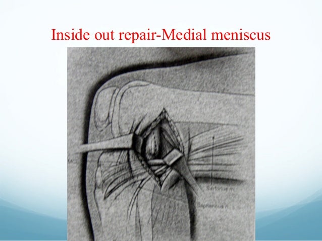 MENISCUS REPAIR