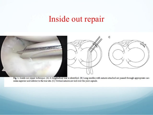 MENISCUS REPAIR