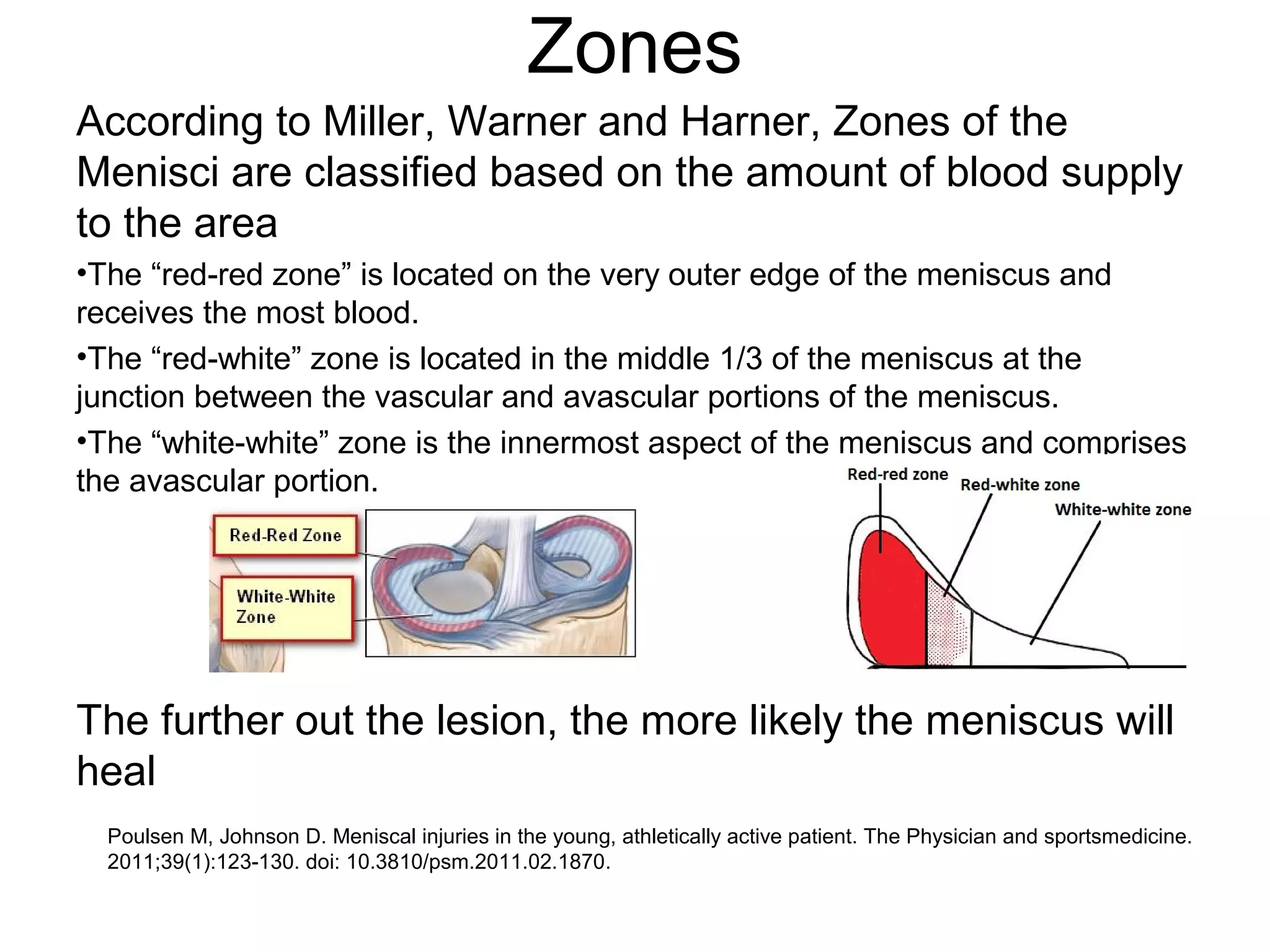 Meniscus repair | PPT