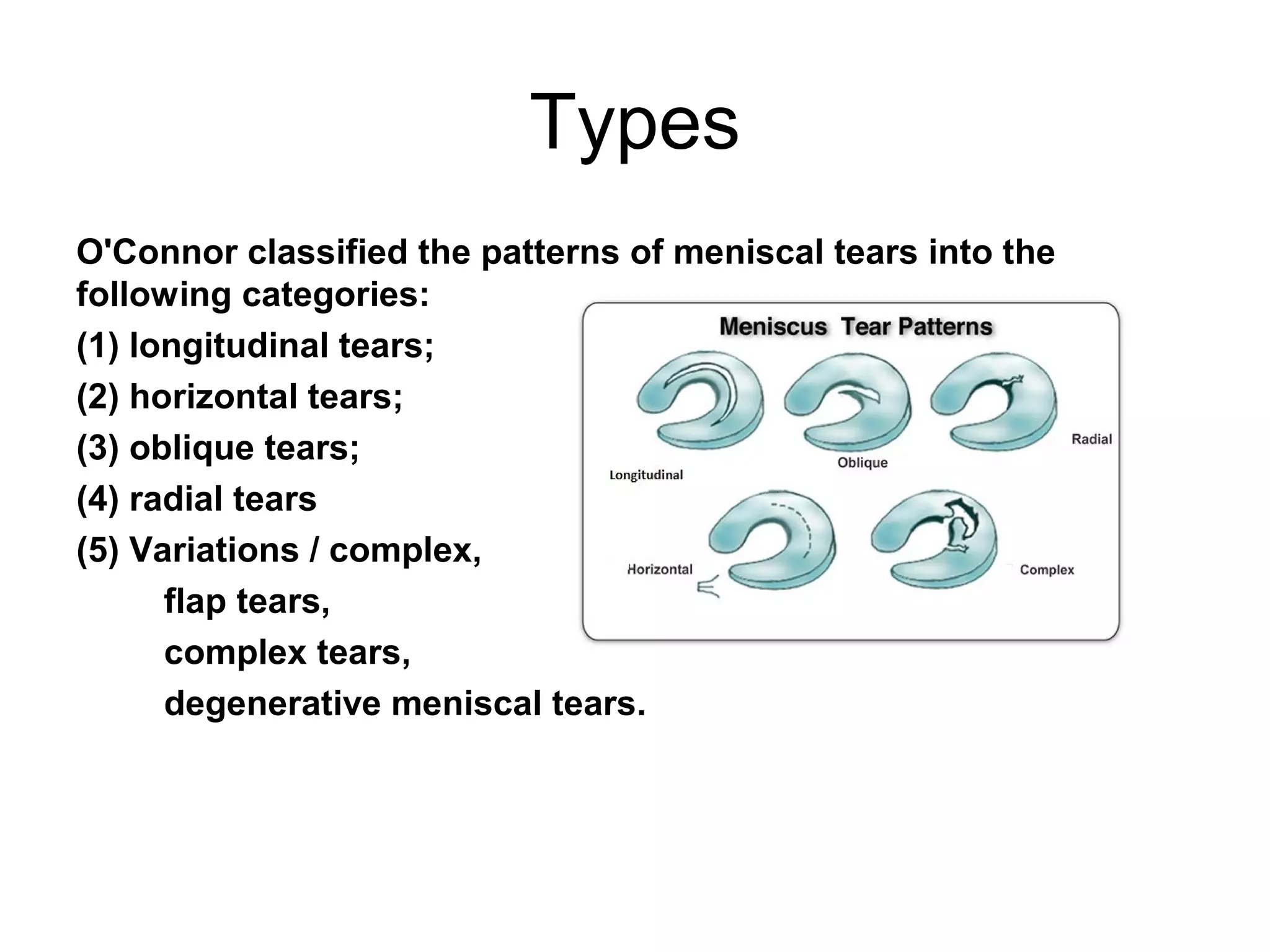 Meniscus repair | PPT