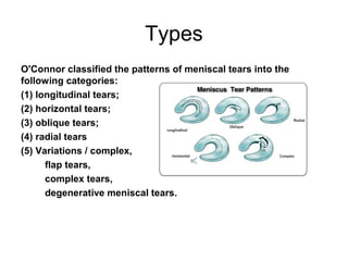 Meniscus repair | PPT