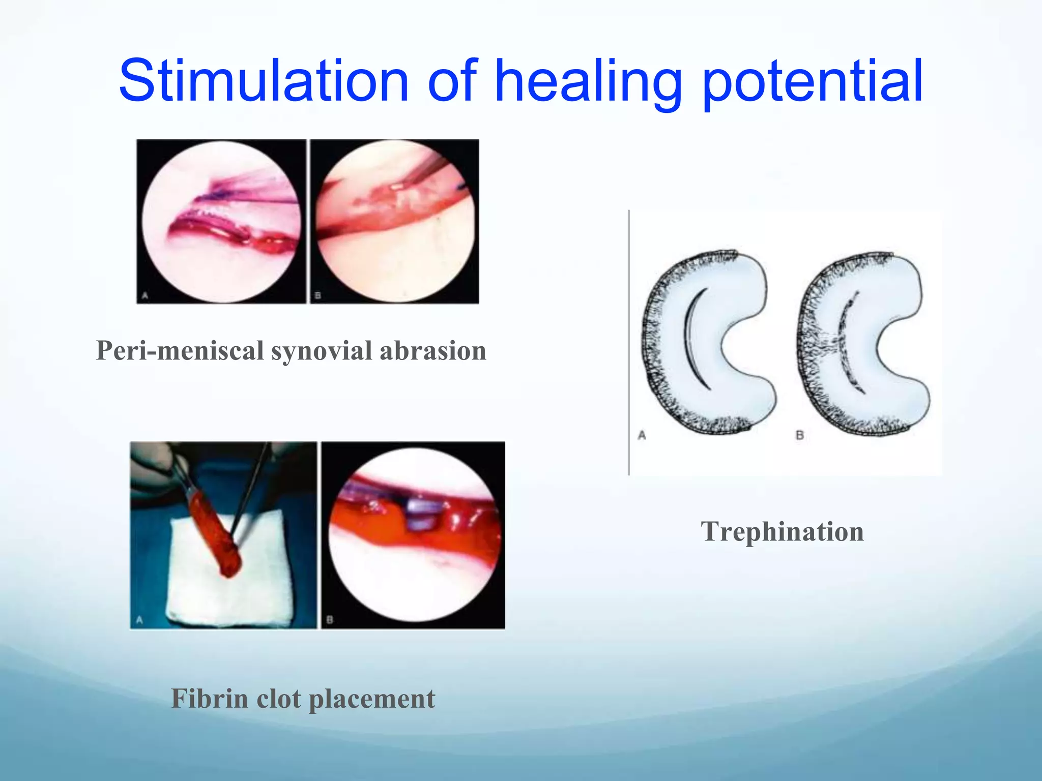 Ideal Indications Meniscus Repair I Dr.RAJAT JANGIR JAIPUR | PPTX