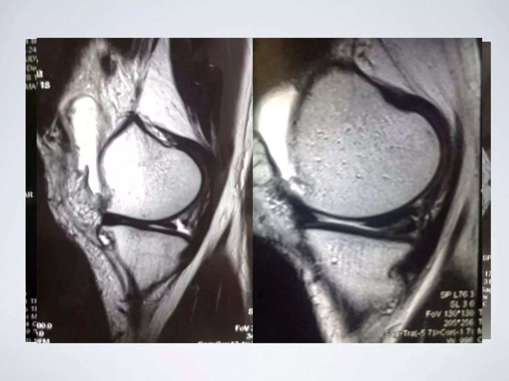 Meniscus repair Indication & Techniques.ppt