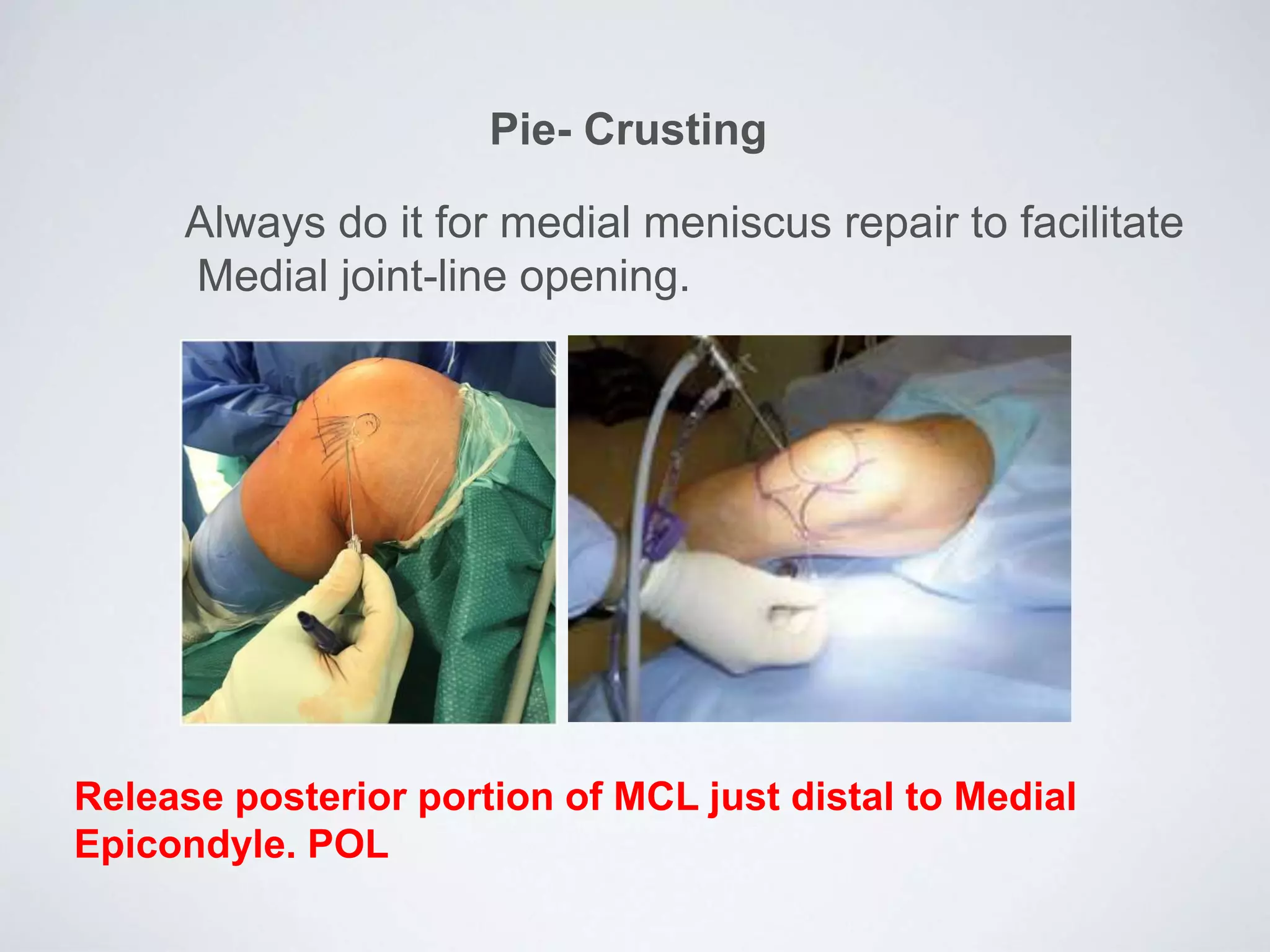 Meniscus repair Indication & Techniques.ppt