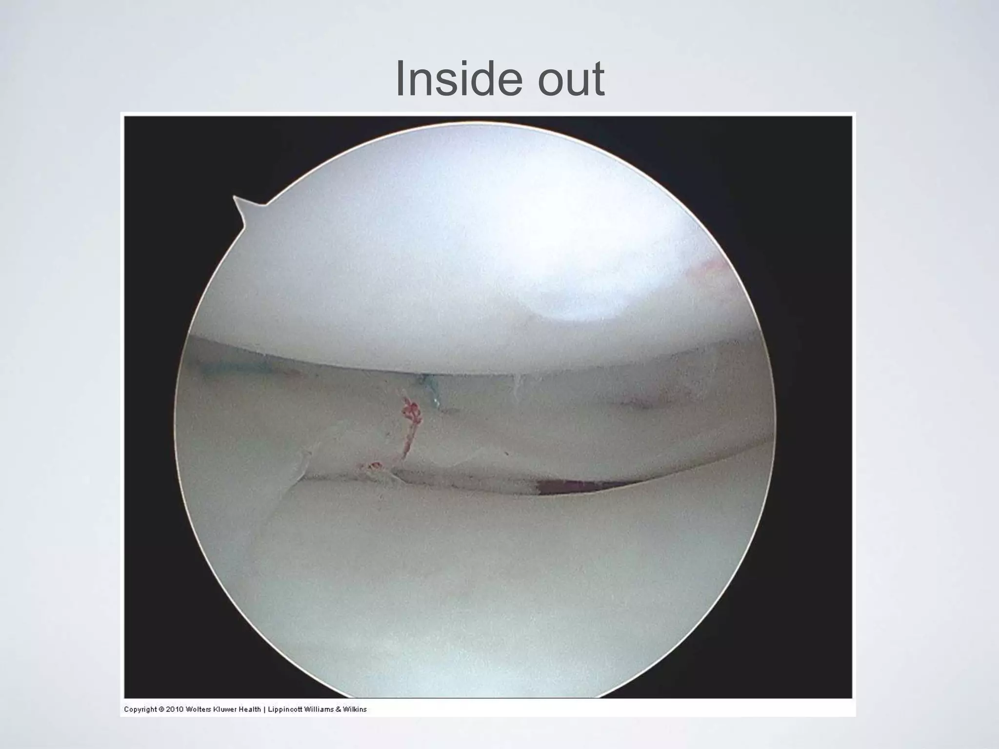 Meniscus repair Indication & Techniques.ppt