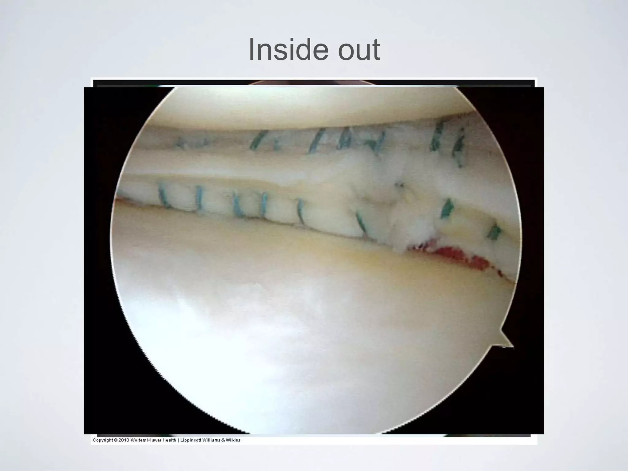 Meniscus repair Indication & Techniques.ppt