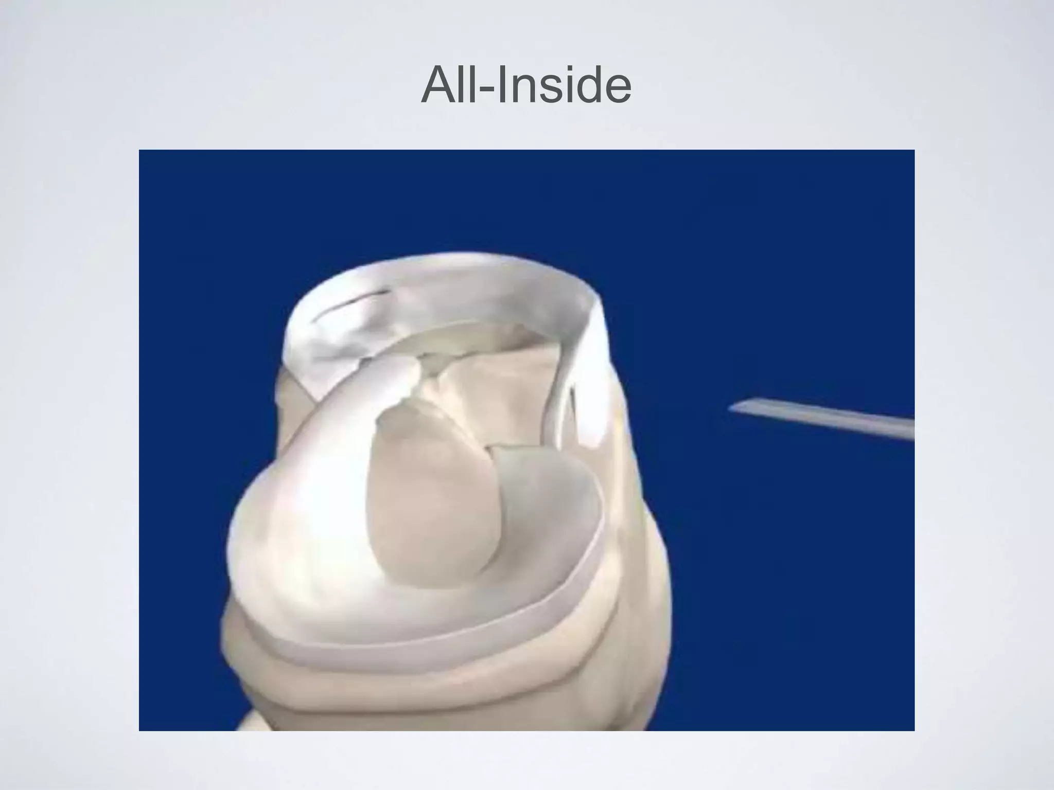 Meniscus repair Indication & Techniques.ppt