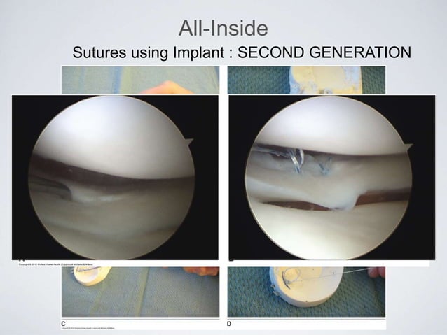 Meniscus repair Indication & Techniques.ppt