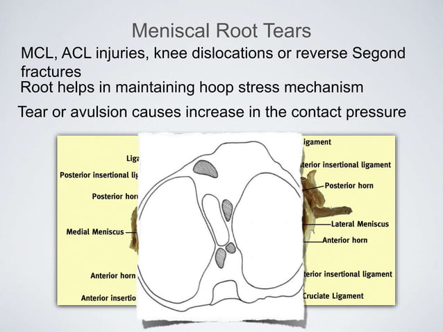 Meniscus repair Indication & Techniques.ppt
