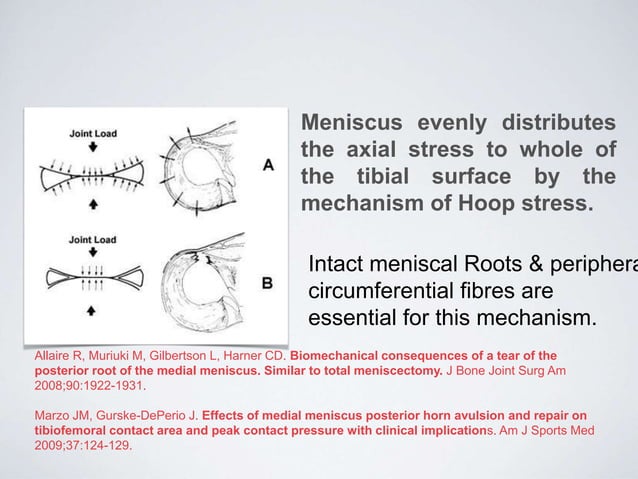 Meniscus repair Indication & Techniques.ppt