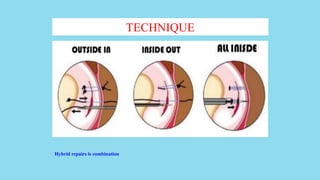 Meniscus repair surgery in Jaipur - Dr.Rajat Jangir | PPT