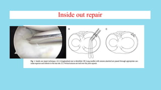 Meniscus repair surgery in Jaipur - Dr.Rajat Jangir | PPT
