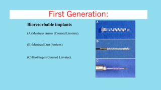 Meniscus repair surgery in Jaipur - Dr.Rajat Jangir | PPT