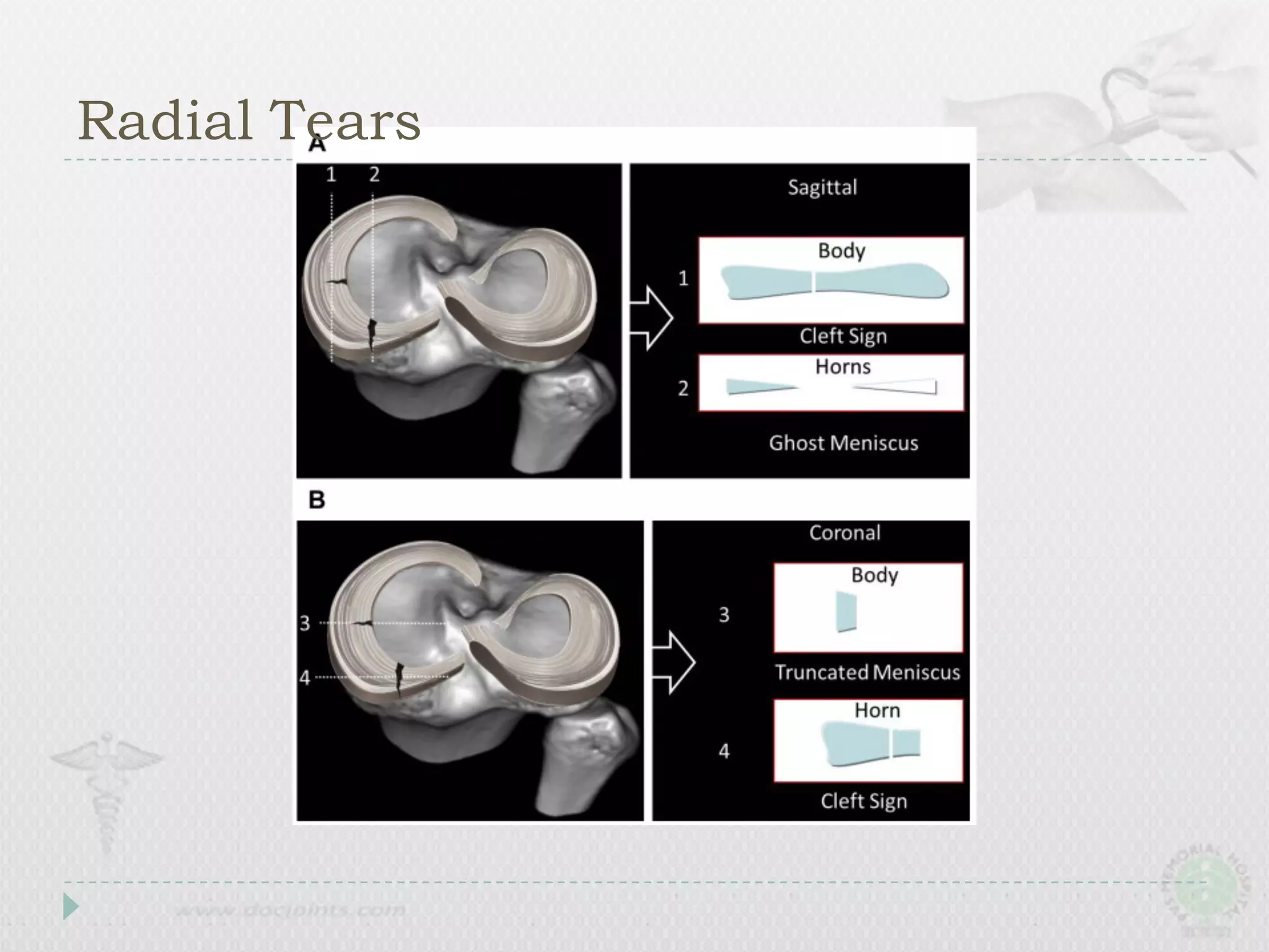 Meniscus repair vs meniscectomy | PDF