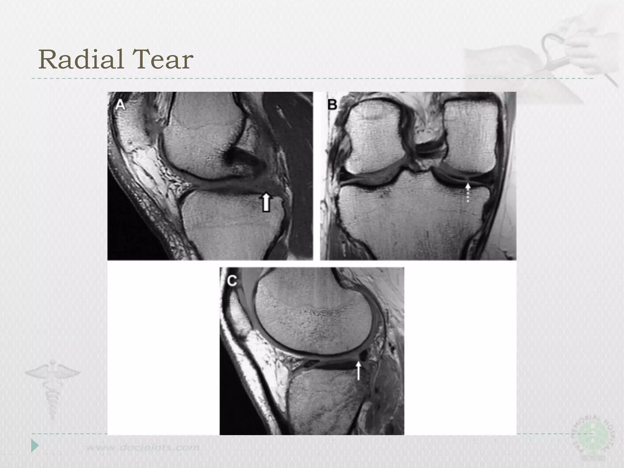 Meniscus repair vs meniscectomy | PDF