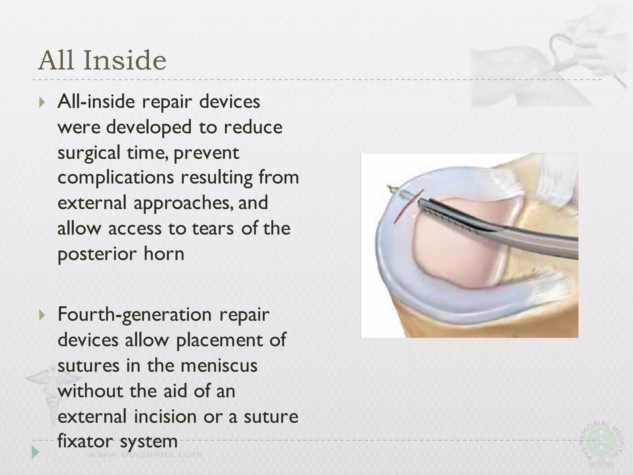 Meniscus repair vs meniscectomy | PDF