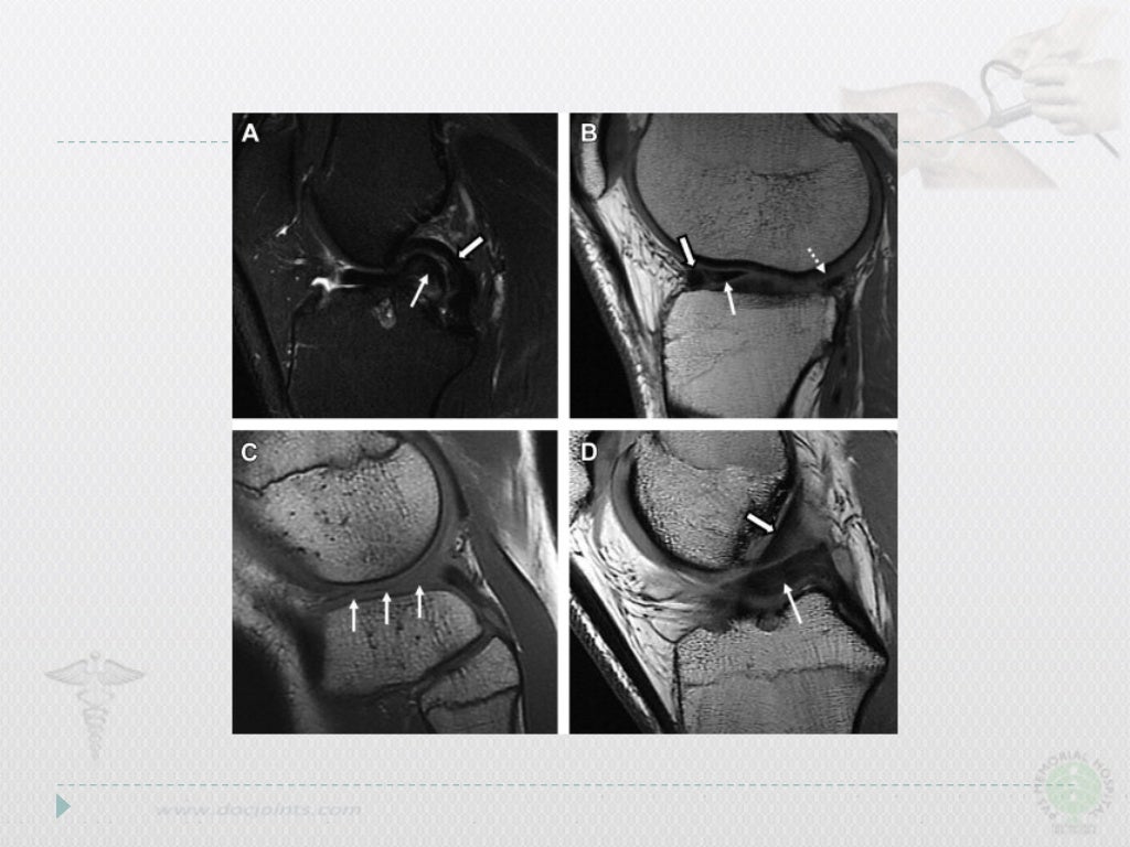 Meniscus Repair Vs Meniscectomy