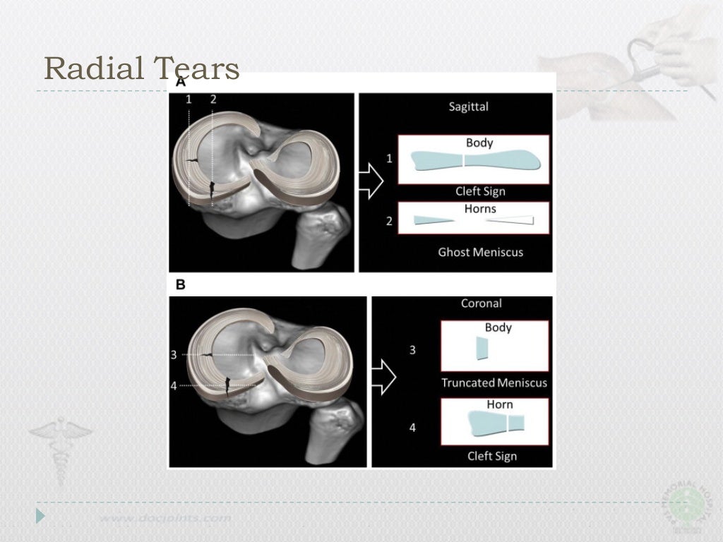 Meniscus Repair Vs Meniscectomy