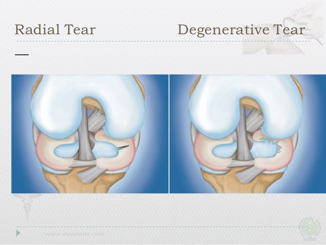 Meniscus Repair Vs Meniscectomy
