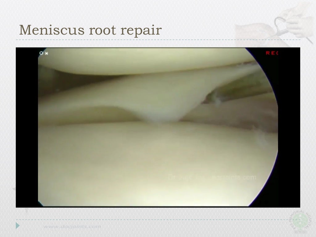 Meniscus Repair Vs Meniscectomy