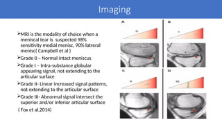 Meniscus, role, treatment. dr. Haki Selaj.pptx
