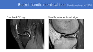 Meniscus, role, treatment. dr. Haki Selaj.pptx | Death, Injury, or ...