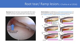 Meniscus, role, treatment. dr. Haki Selaj.pptx | Death, Injury, or ...