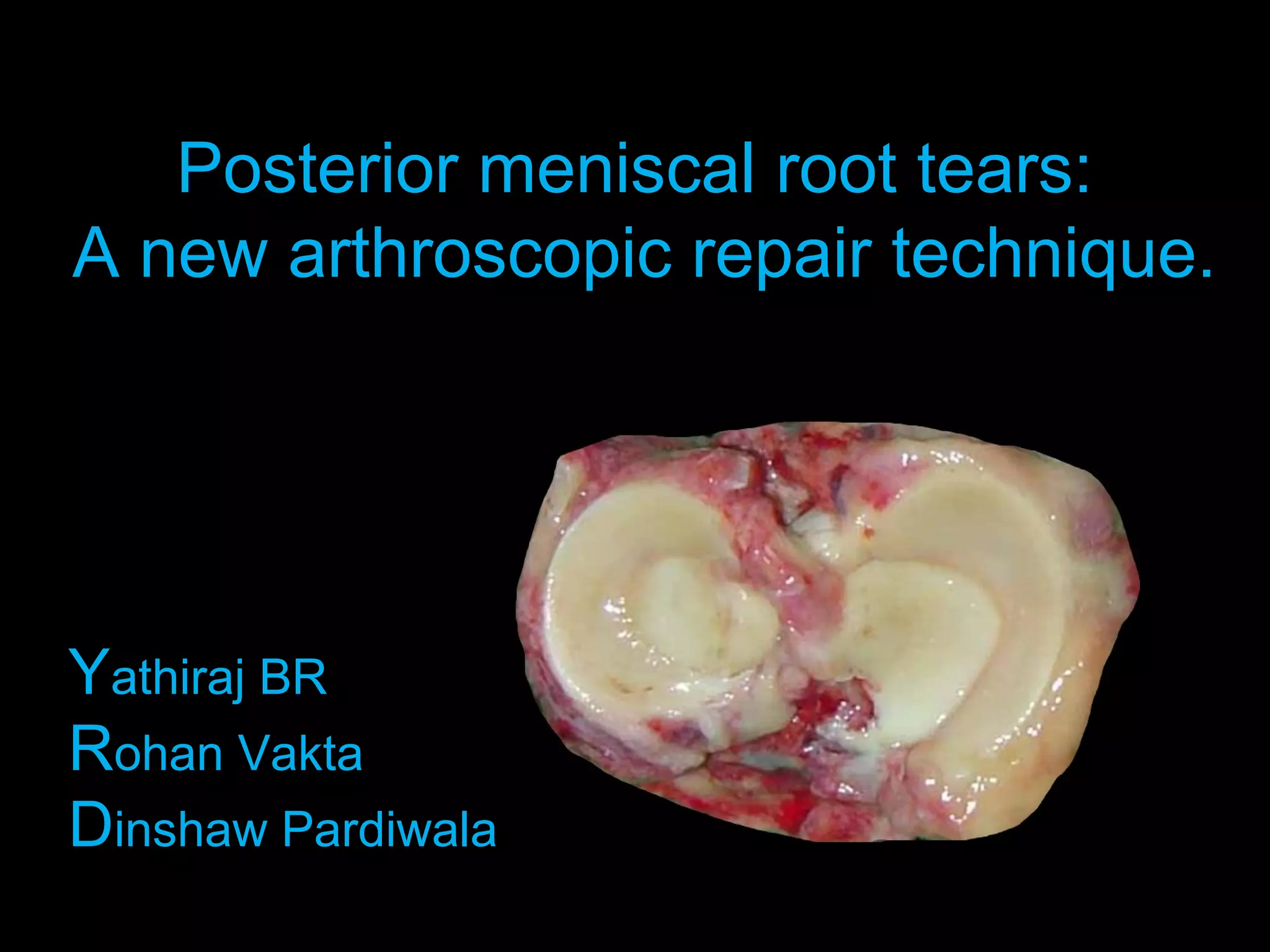 Posterior Meniscal Root Tear Repair Technique-Dr. Yathiraj BR et al | PPT
