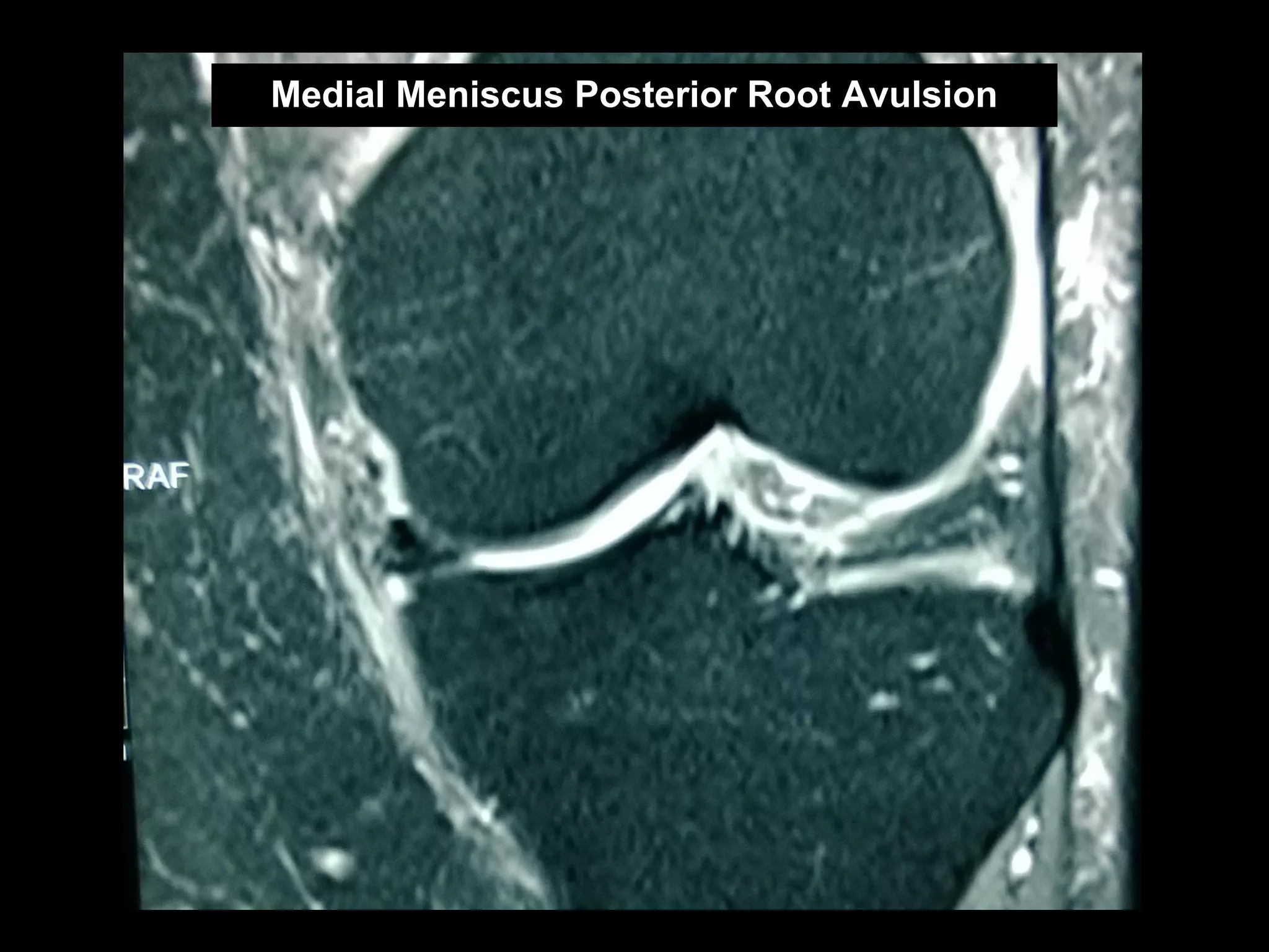 Posterior Meniscal Root Tear Repair Technique-Dr. Yathiraj BR et al | PPT
