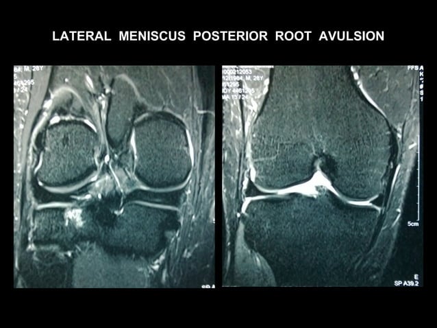 Posterior Meniscal Root Tear Repair Technique-Dr. Yathiraj BR et al ...