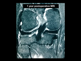 Posterior Meniscal Root Tear Repair Technique-Dr. Yathiraj BR et al | PPT