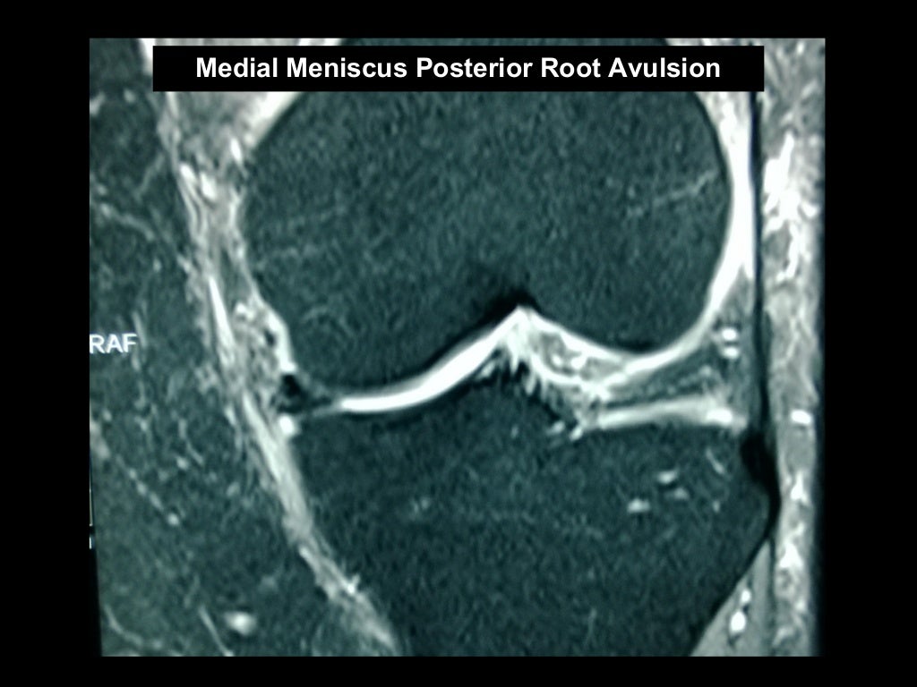 Posterior Meniscal Root Tear Repair Technique-Dr. Yathiraj BR et al