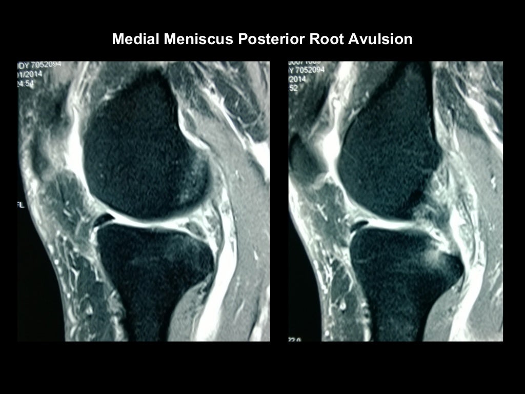 Posterior Meniscal Root Tear Repair Technique-Dr. Yathiraj BR et al