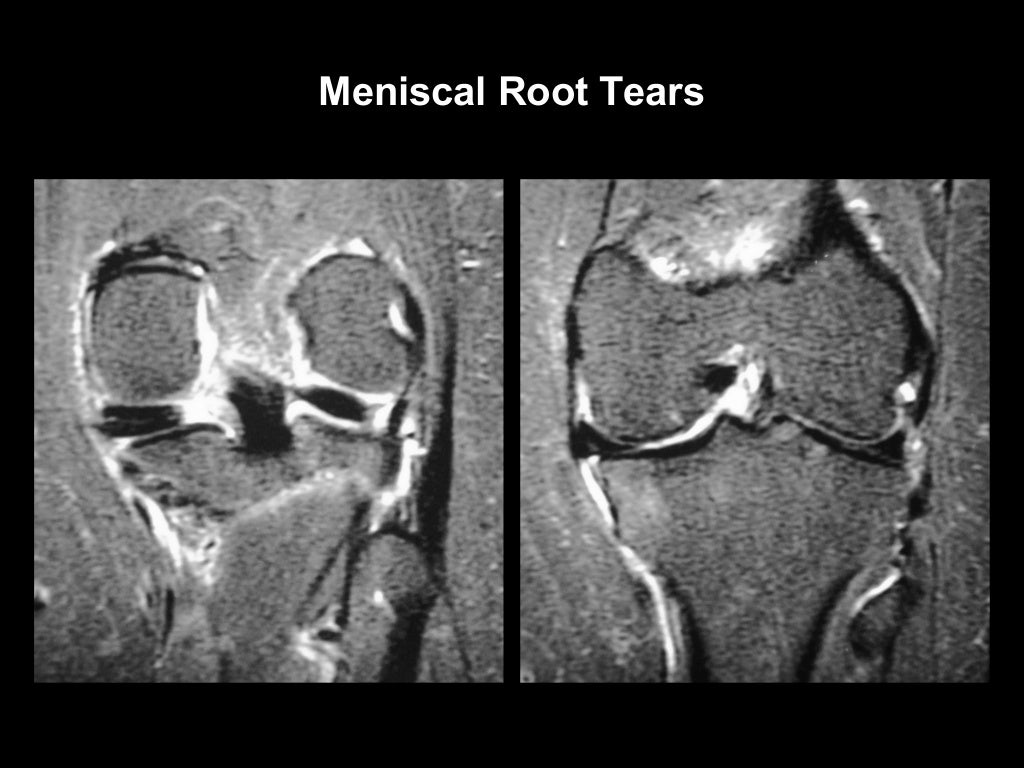 Posterior Meniscal Root Tear Repair Technique-Dr. Yathiraj BR et al