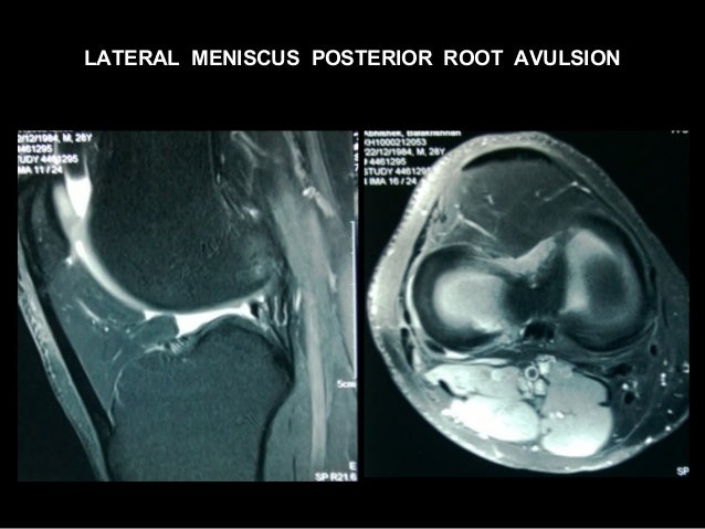 Posterior Meniscal Root Tear Repair Technique-Dr. Yathiraj BR et al