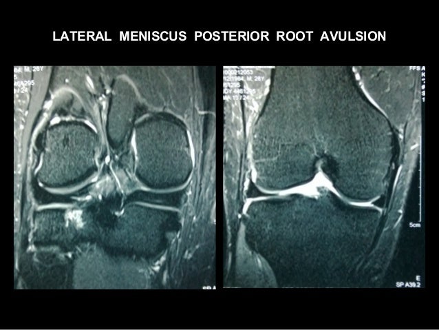 Posterior Meniscal Root Tear Repair Technique-Dr. Yathiraj BR et al
