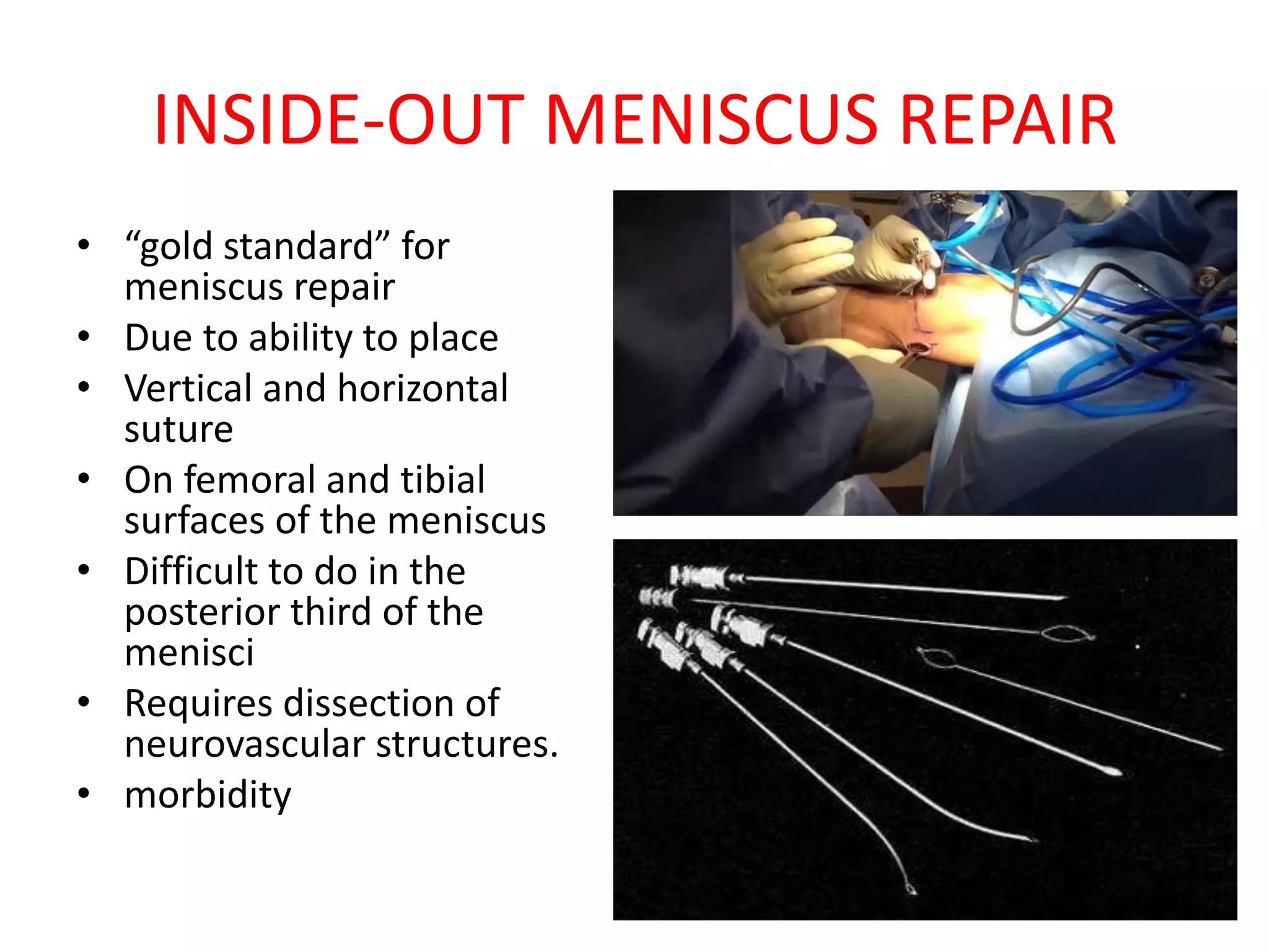 MENISCUS SURGERY.pptx