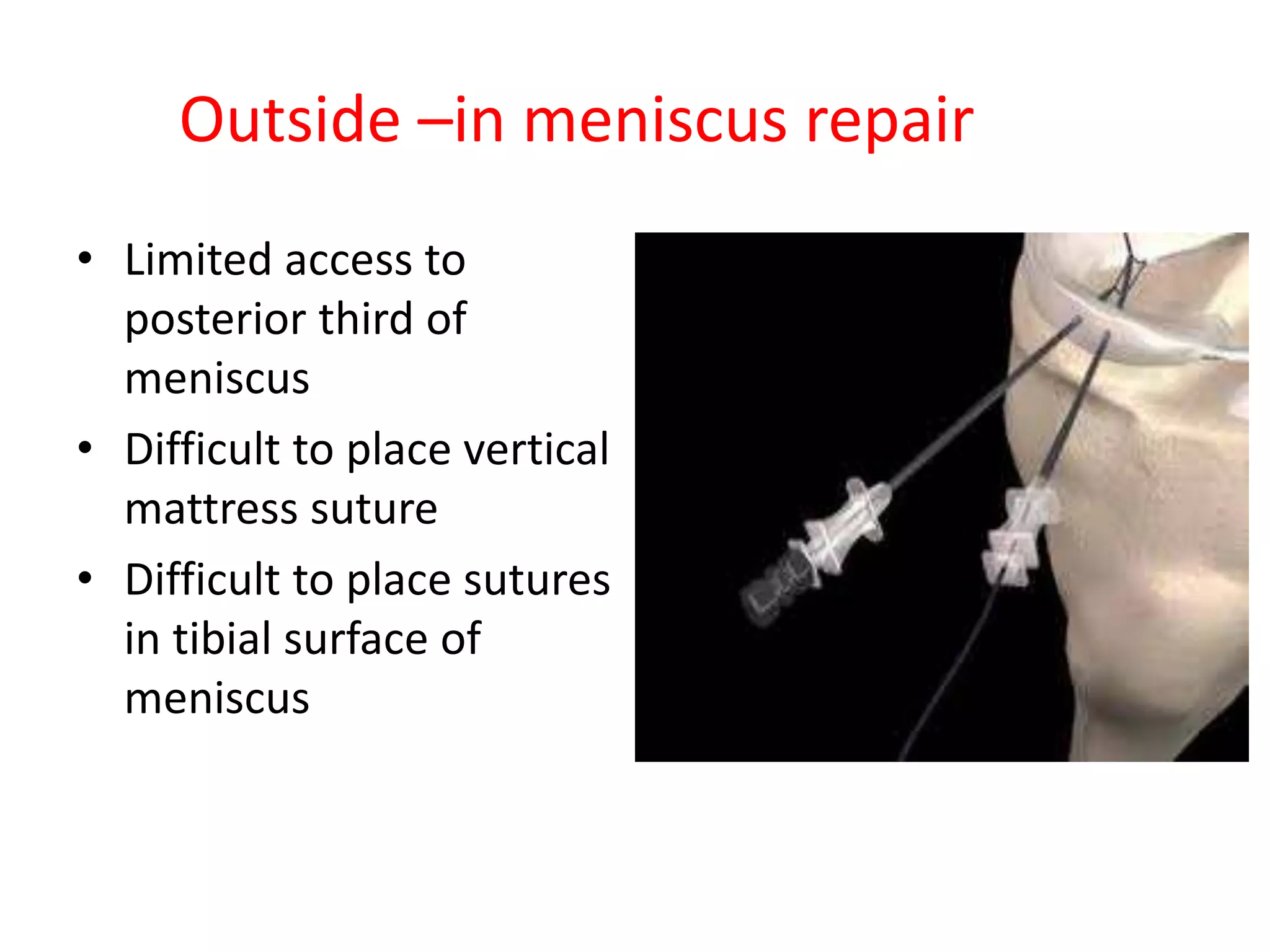 MENISCUS SURGERY.pptx