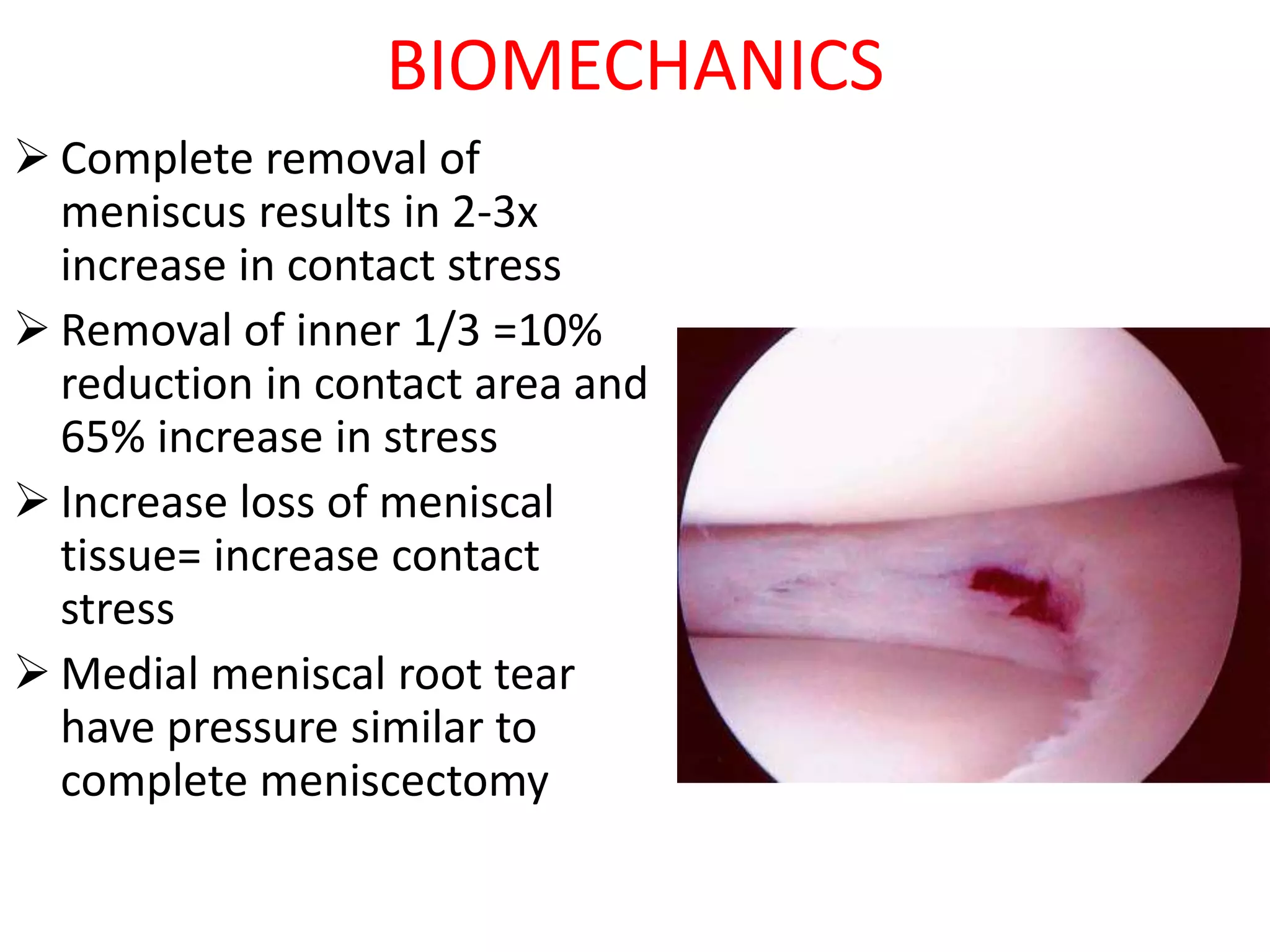 MENISCUS SURGERY.pptx