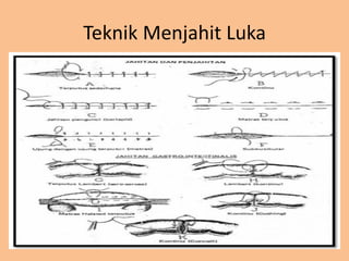 Menjahit Luka. Menjahit luka. Menjagit luka | PDF
