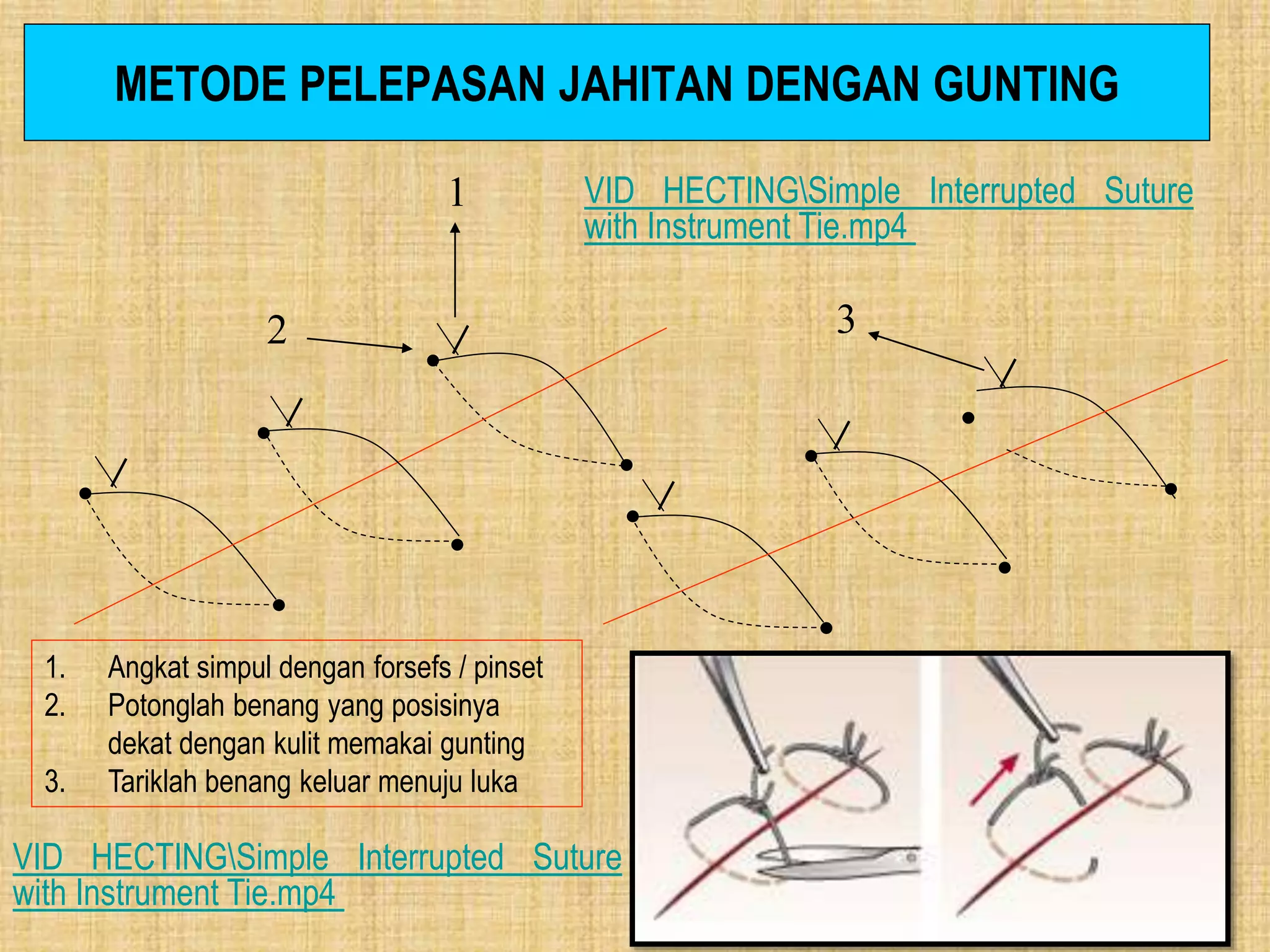 Menjahit Luka Dengan Bermacam Teknik | PPTX