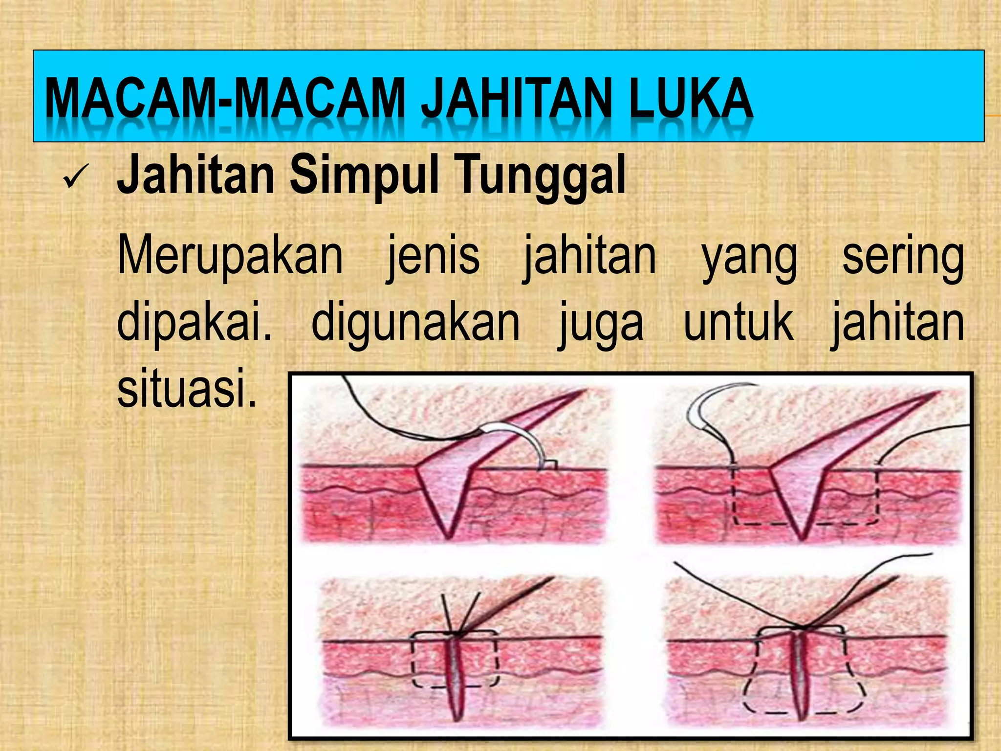 Menjahit Luka Dengan Bermacam Teknik | PPTX