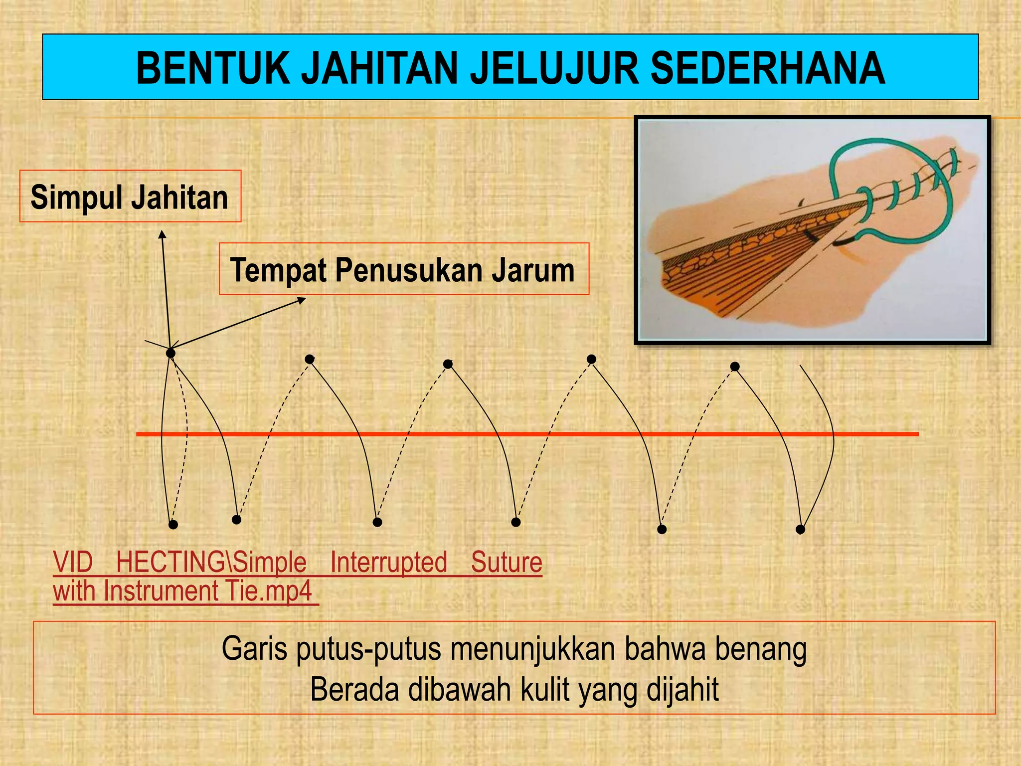 Menjahit Luka Dengan Bermacam Teknik | PPTX