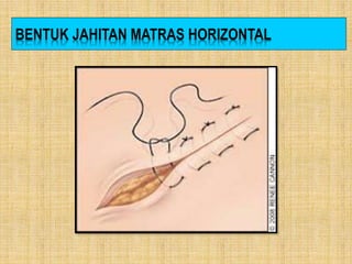 Menjahit Luka Dengan Bermacam Teknik | PPTX