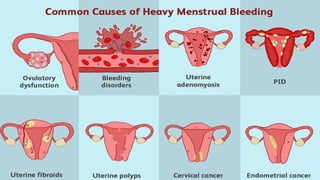 Types of Menstrual disorders and there causes and symptoms | PDF