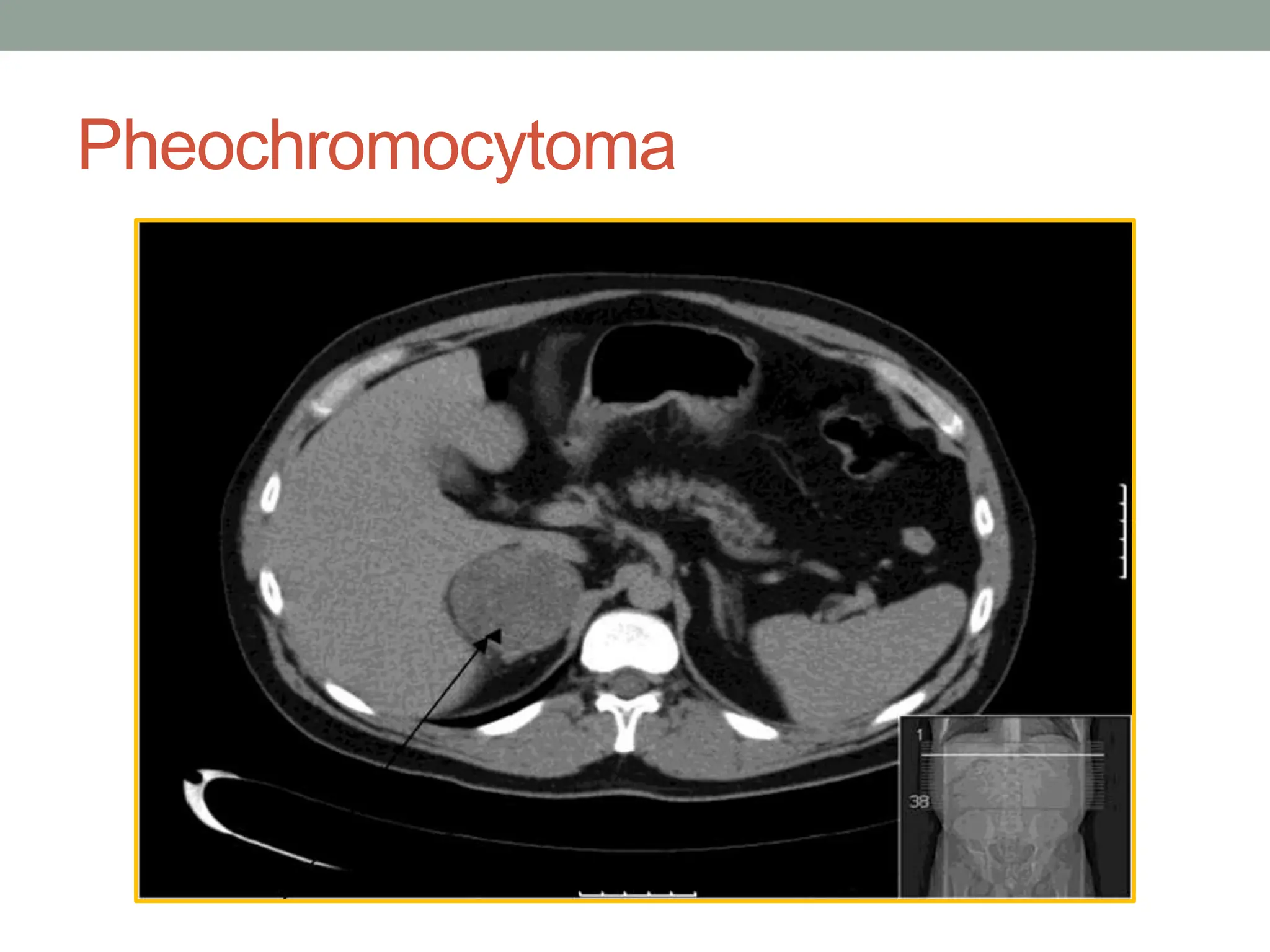 men syndrome. ppt genomic and genetics | PPTX