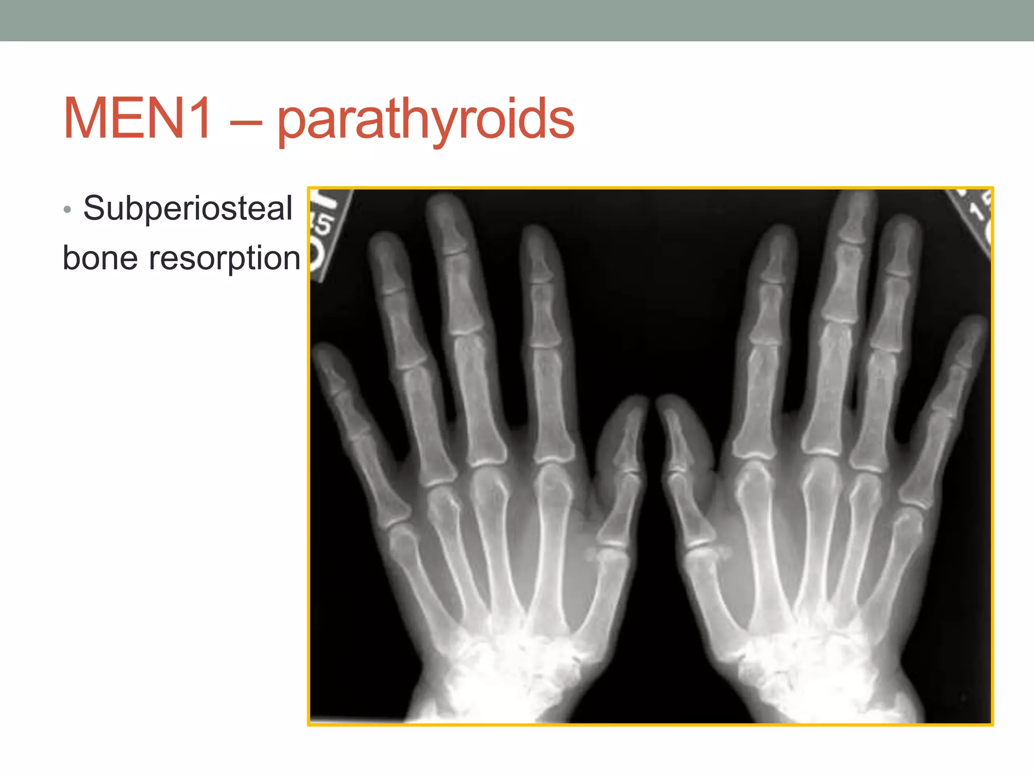 Men syndromes | PPTX