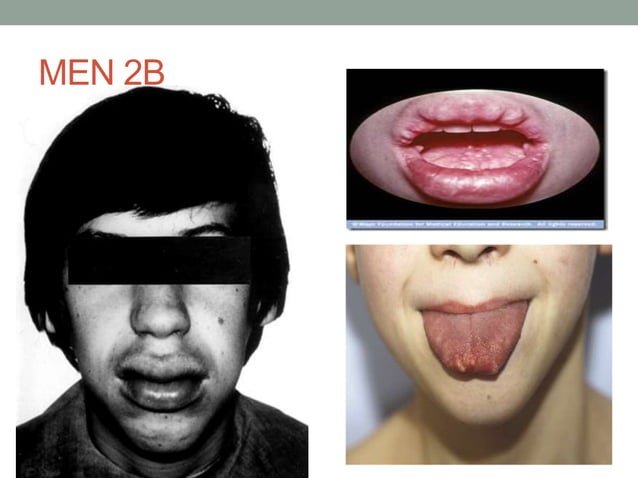 Men syndromes | PPTX