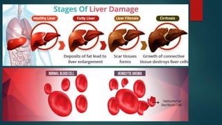 liver function tests (LFTs) | PPTX | Blood Disorders | Diseases and ...